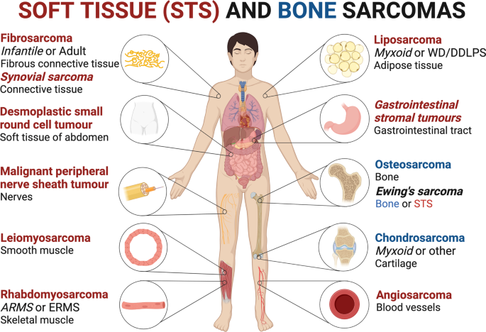 Sarcoma: Symptoms, diagnosis, and treatment options